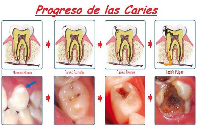 Caries